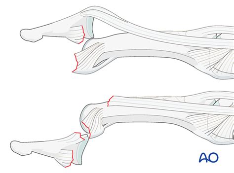 Dislocation Of The Distal Interphalangeal Joint
