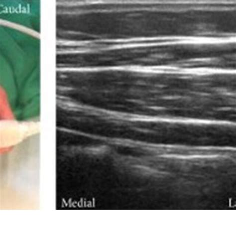 Lateral Approach For Transversus Abdominis Plane Tap Block A The
