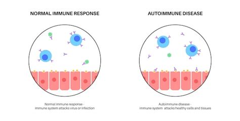 Premium Vector Autoimmune Hepatitis Disease