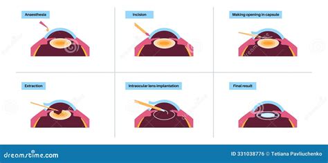 Cataract Surgery Poster Cartoon Vector 329817215
