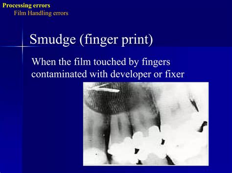 Radiographic Errors And Artifacts Pptx Photo Editing Software