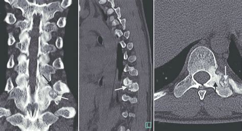 A 21 Year Old Male With A Left D9 Transverse Process Osteoid Osteoma Download Scientific