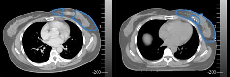 Elastix Masking Registration Support 3d Slicer Community