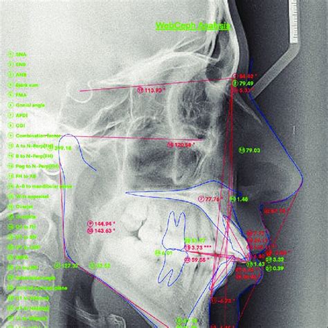 Pdf Evaluation Of The Position And Incidence Of Impaction Of Mandibular Third Molars In