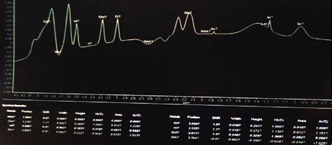 Magnetic Resonance Spectroscopy Mrs Showing Normal Mr Spectrum With