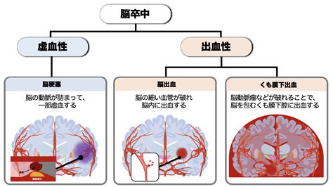 脳卒中ってどんな病気？ 愛知県豊橋市で脳梗塞・脳出血後遺症の麻痺に特化したマンツーマンリハビリならactive｜脳梗塞リハビリactive
