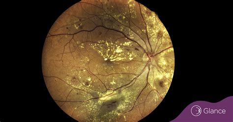 Researchers Update The Areds Simplified Severity Scale