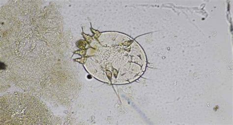 Woman Eaten Alive By Mites In A Hospital 5 Facts About Scabies That You Should Know