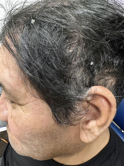 Seborrheic Dermatitis Stock Image C0601527 Science Photo Library