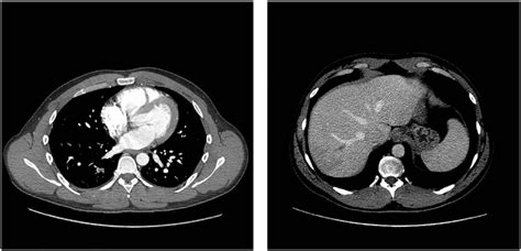 Shows Multiple Segmental And Subsegmental Pulmonary Emboli Throughout