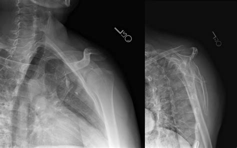 Comminuted Scapular Fracture