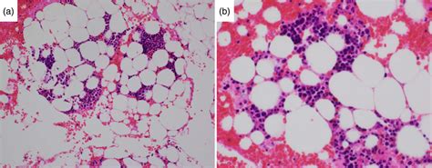 A B Bone Marrow Findings Indicative Of Therapy‐related Download Scientific Diagram