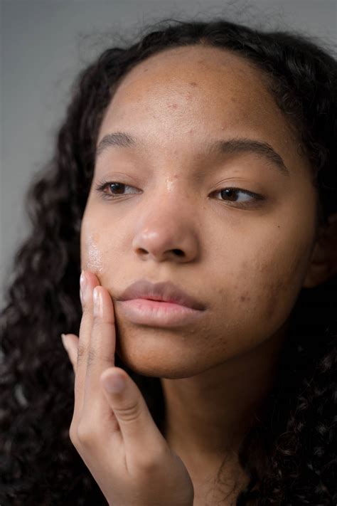 Benzoyl Peroxide An Ally Against Acne