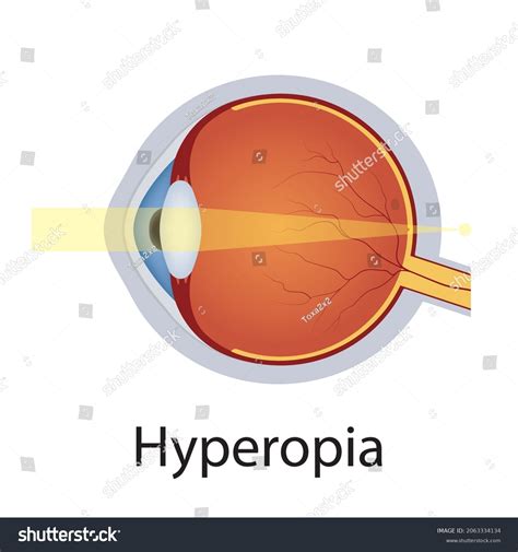 Hyperopia Vision Disorders Illustration Eyes Defect Stock Vector Royalty Free 2063334134
