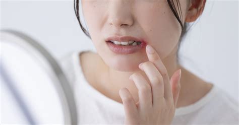 口内炎 エヌ・エイ歯科クリニック