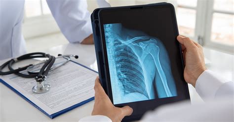 Une Découverte Lève Le Voile Sur Le Mystère Dune Maladie Osseuse Rare Le Bulletel