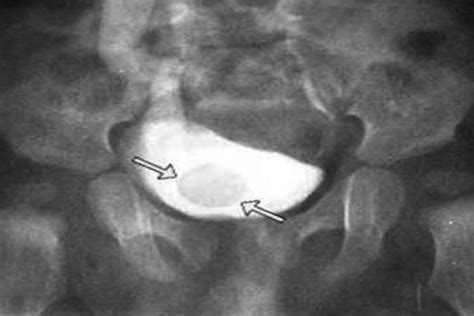Ectopia Renal Simple
