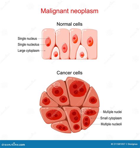 Malignant Neoplasm Metastases On Mobile App Onboarding Screens Ui Ux