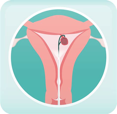 Complete Guide To Endometrial Polyps Symptoms And Treatment