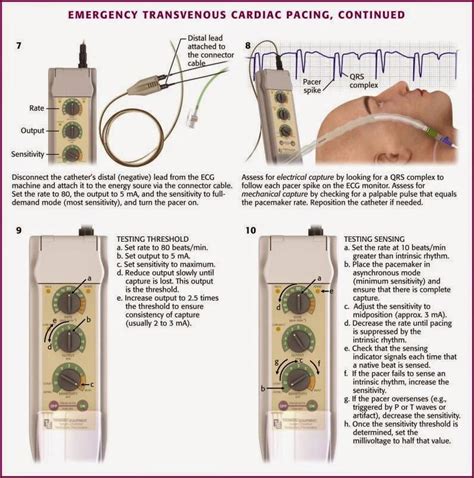 Electrodes For Cardiac Pacing At Richard Groves Blog