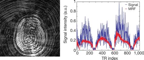 Magnetic Resonance Fingerprinting Mrf Quantitative Mri Resources
