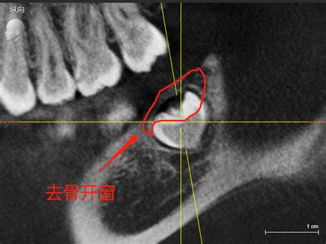 左下牙囊拔除一例 贵阳胡牙医的博客 KQ88口腔博客