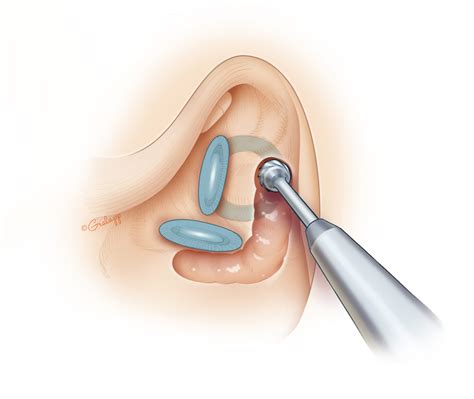 Labyrinthectomy Oto Surgery Atlas