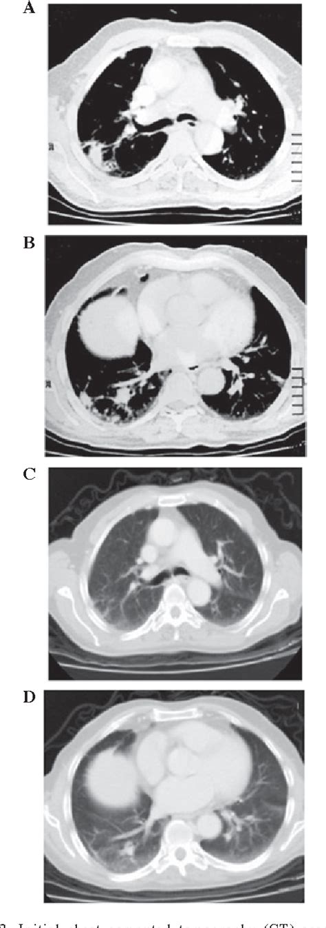 Figure 2 From Pilomatrix Carcinoma Of The Scalp With Pulmonary Metastasis A Case Report Of A