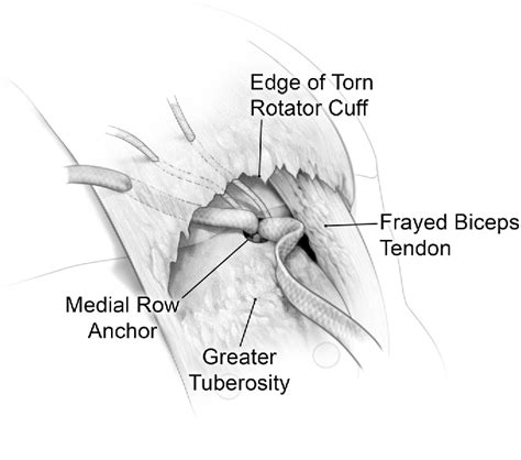 Figure 1 From Novel All Arthroscopic Biceps Tenodesis Technique Incorporated Into Rotator Cuff