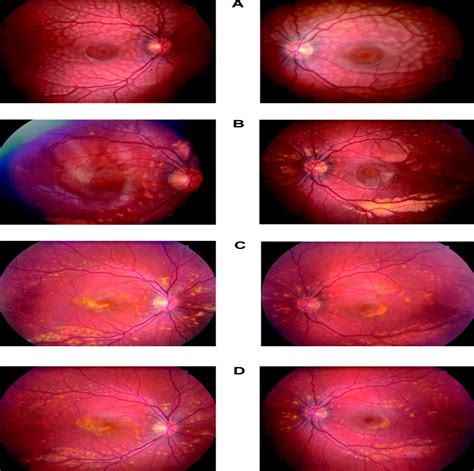 Persistent Cone Dysfunction In Acute Exudative Polymorphous Retina