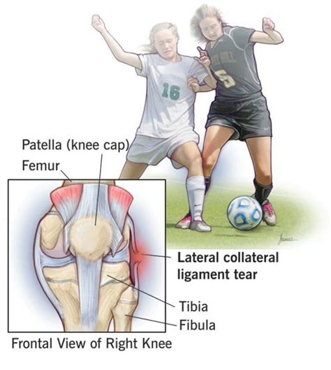 Lcl Tear Symptoms Causes Treatment By Knee Braces