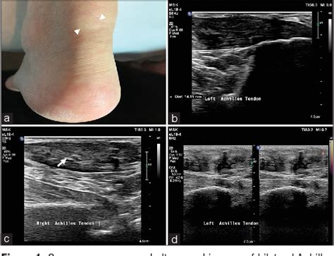 Figure 1 From A 73 Year Old Man With Bilateral Posterior Ankle Pain