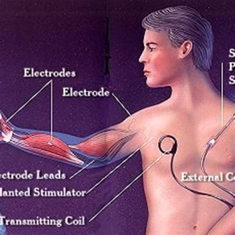 Pdf Functional Electrical Stimulation Fes Review