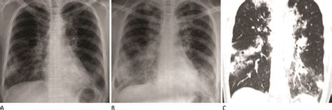Churg Strauss Syndrome With Cardiac Involvement A Case Report With Ct