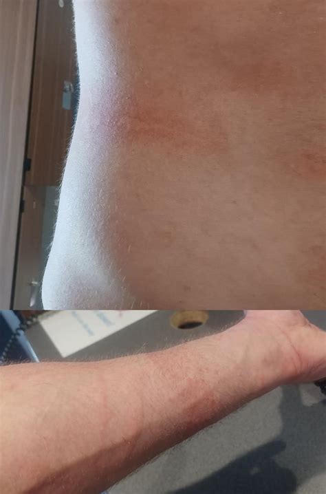 Infection Causing Both Flu Like Symptoms And Rash Or Coincidence R