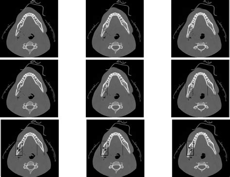 figure 1 from hairline fracture detection using mrf and gibbs sampling