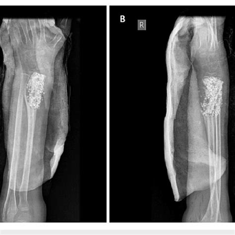 Check X Ray At The End Of Two Months Showing The Incorporation Of Both