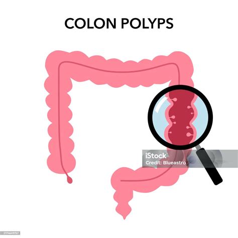 Colonoscopy Intestine Polypectomy Procedure Removal Polyp In Colon Checkup Gut Colon Surgery