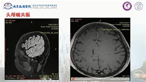 基底动脉近端动脉瘤血流导向装置置入术