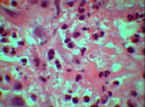 Unusual Presentation Of Chronic Hyperplastic Pulpitis A Case Report Pmc