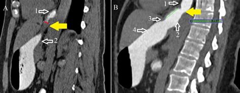 A Ct Sagittal Section Showing The Distal Esophagus Arrow 1 The