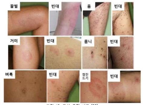 모기·진드기에 물린 자국 빈대와는 이렇게 다르다