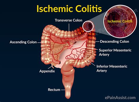 What Causes Ischemic Colitis Know Its Symptoms Pathophysiology Etiology