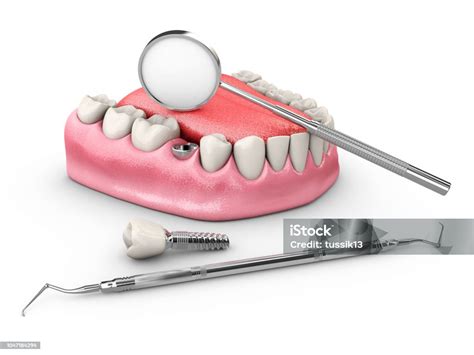 인간의 치아와 임 플 란 트 3 차원 일러스트 레이 션 강철에 대한 스톡 사진 및 기타 이미지 강철 건강관리와 의술 골절