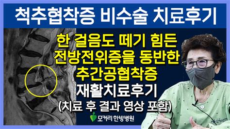 척추전방전위증을 동반한 추간공협착증으로 한 걸음도 떼기 힘든 환자의 비수술 재활치료 사례 강남모커리한방병원 척추관협착증센터