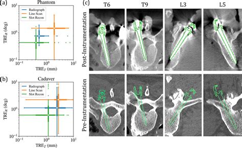 Registration Of Pedicle Screws Using Dual Plane Radiographs Download Scientific Diagram