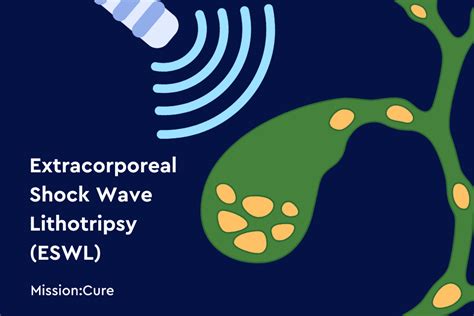 Extracorporeal Shock Wave Lithotripsy Best Extracorporeal Shock Wave
