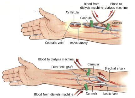 What Is Av Fistula Surgery