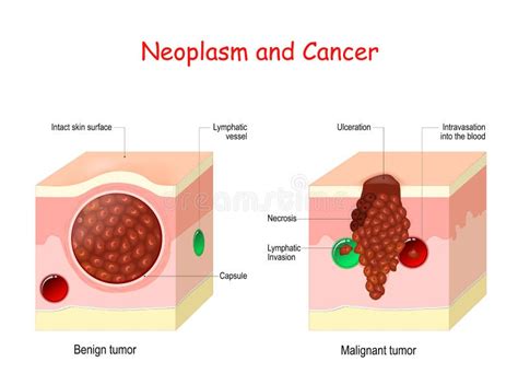 Cancer And Neoplasm Comparison And Difference Between Malignant And Benign Tumor Stock Vector