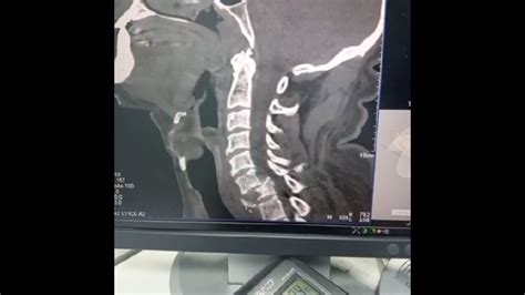 Omar Al Awar Md On Linkedin C7 Corpectomy With Anterior Fixation Mount Lebanon Hospital